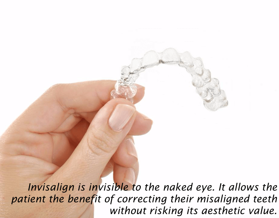 Invisalign aligners: To choose or not to choose? - Discovery Dental